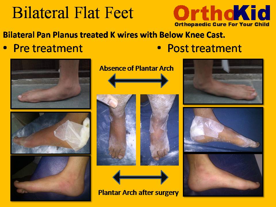 Bilateral Flat Feet Bilateral Flat Feet