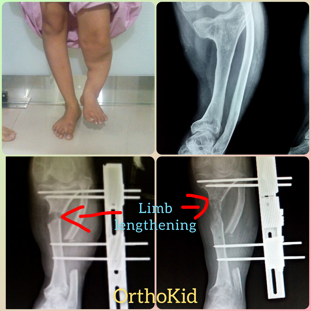 Lower Limb Orthopedic Surgeon | Pediatric Expertise