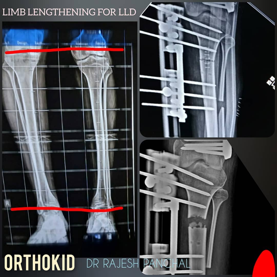 LIMB LENGTHENING FOR ADULT WITH LLD BY LRS SYSTEM CORTICOTOMY WITH ... LIMB LENGTHENING FOR ADULT WITH LLD BY LRS SYSTEM CORTICOTOMY WITH ...